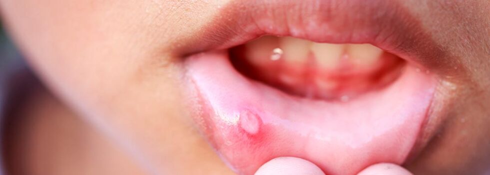 ¿Qué son las aftas?