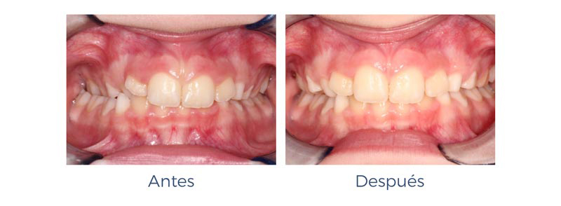 Disyunción Maxilar - Clínica Versalles